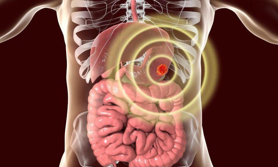 What Are the Differences Between Benign and Malignant Types of GIST ...