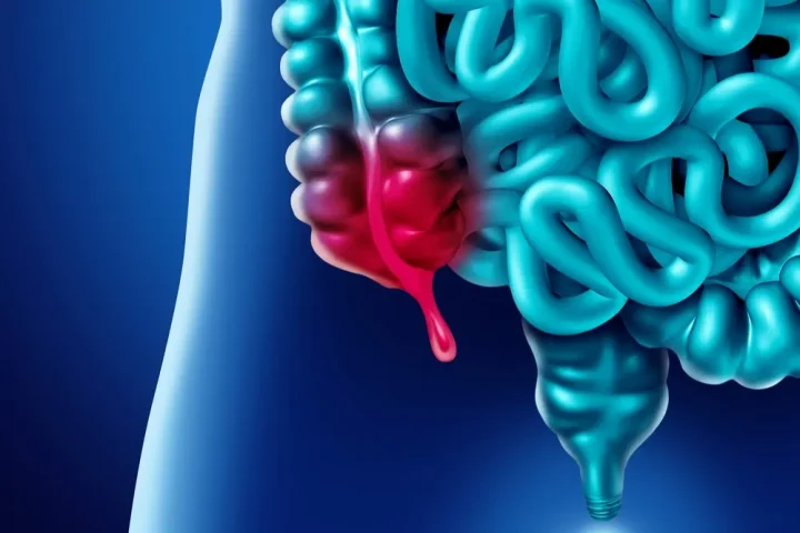 What causes bloating after an appendectomy, and how can it be prevented ...