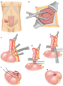 Quel est le processus de récupération après une appendicectomie et quelles sont les périodes ...