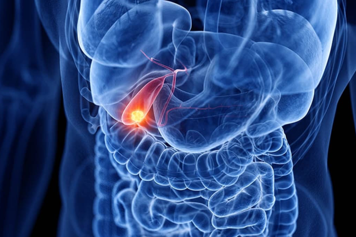 Quem tem mais probabilidade de desenvolver câncer do ducto biliar ...