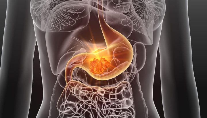 How is the risk of GIST recurrence and metastasis assessed? - Expert ...