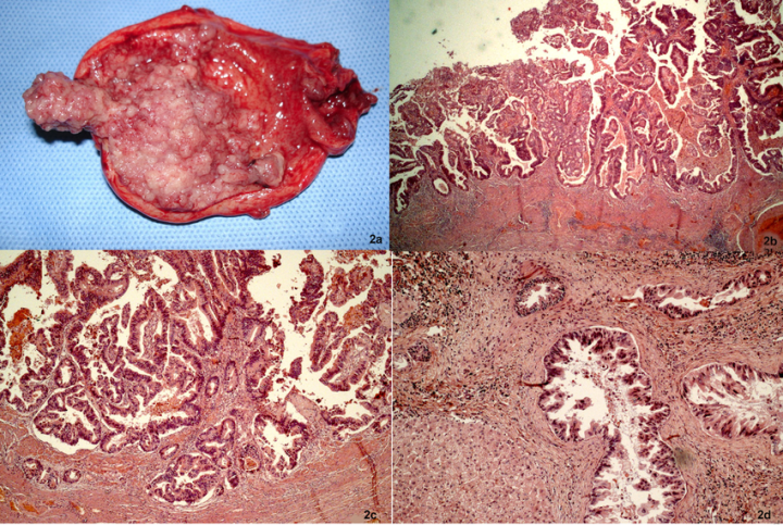 Quais problemas do ducto biliar e do pâncreas afetam a papila de Vater ...
