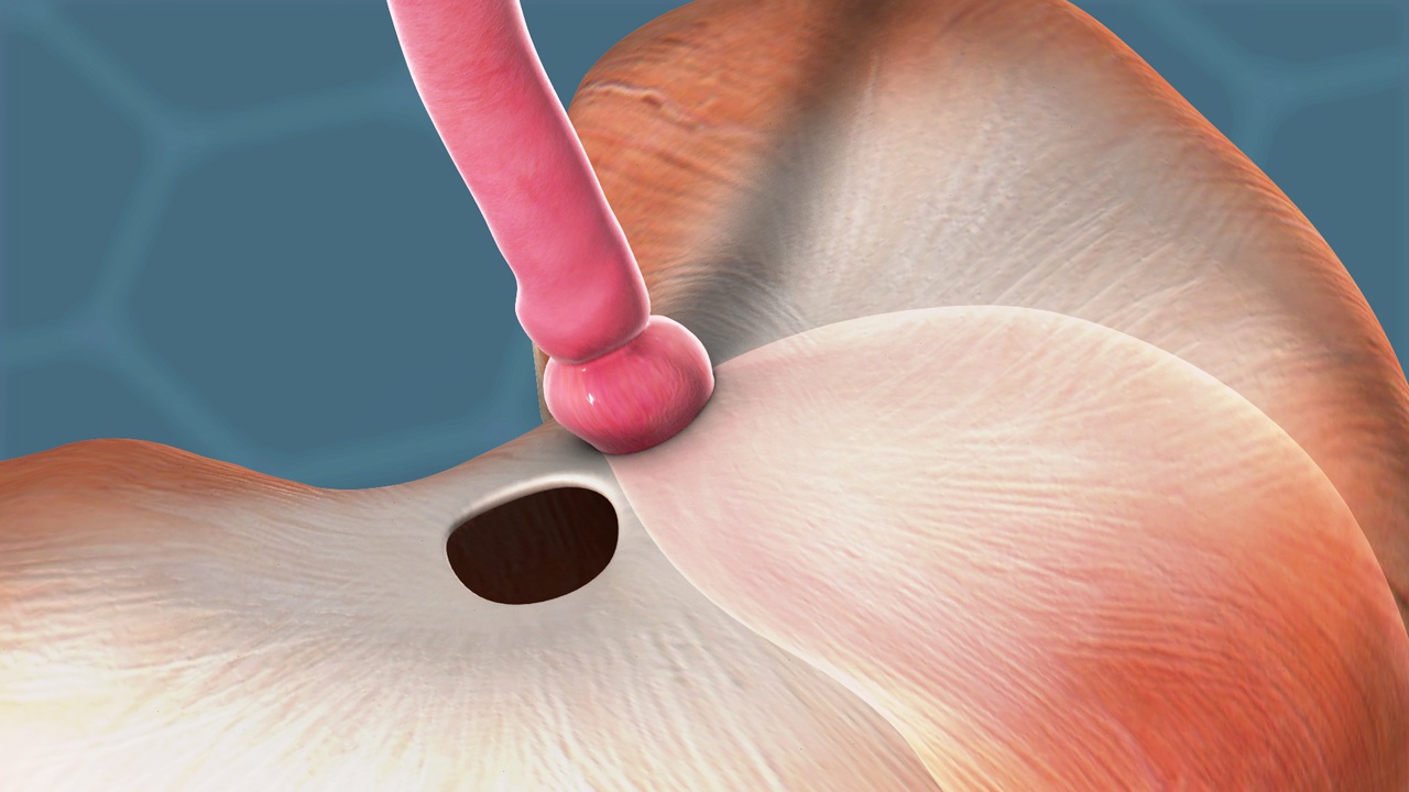 Who is more prone to developing a stomach hernia? - Expert Cancer Surgeon