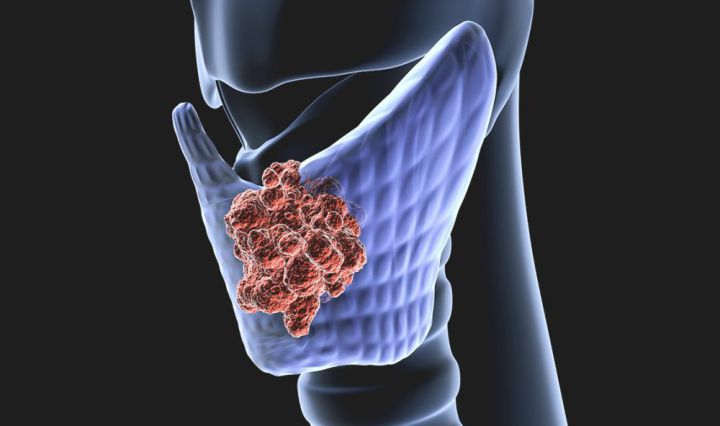 Can Thyroid Cancer Spread in the Body? - Expert Cancer Surgeon