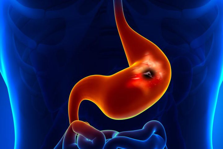 Is there a connection between ulcers and stomach cancer? - Expert ...