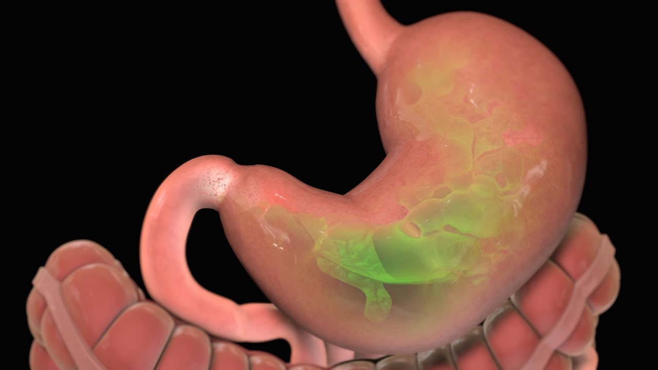 What are the complications of ulcers and how can they be prevented ...