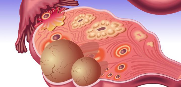 What is the Process of Surgical Removal for Benign Tumors? How Does ...