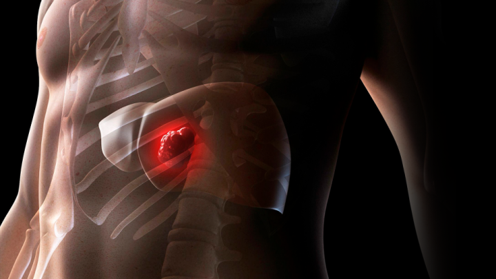 Under What Conditions Do Liver Echinococcal Cysts Develop and How Do ...