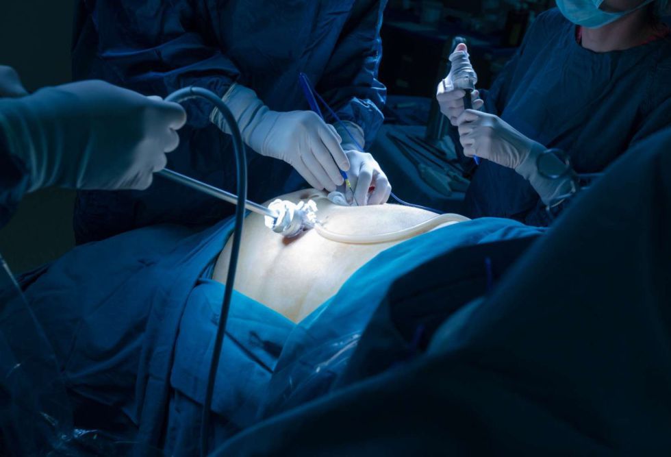 What Is the Role and Importance of PIPAC Treatment in Cancer Therapy ...